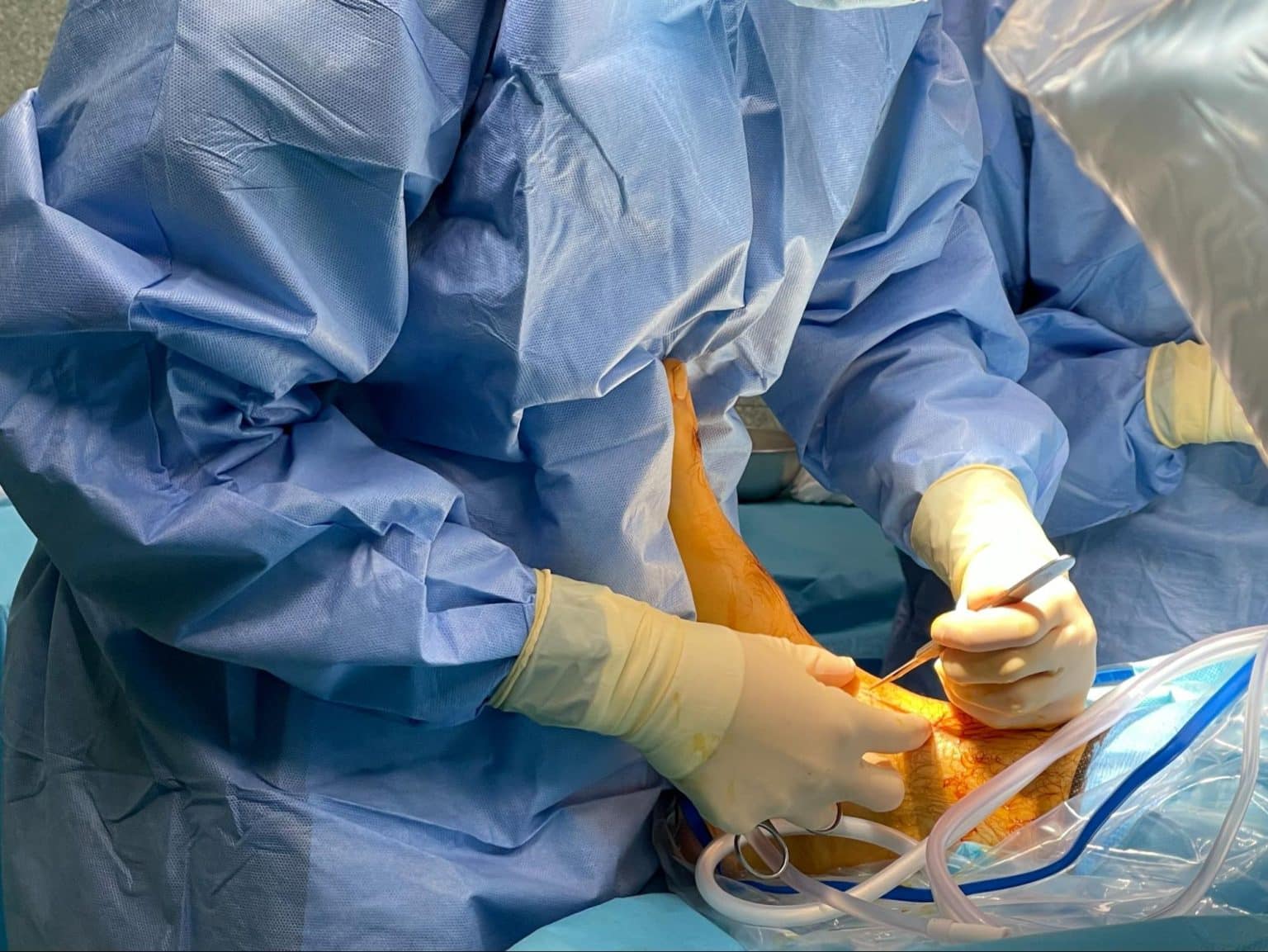 Osteocondritis disecante de tobillo | TRAUMADRID
