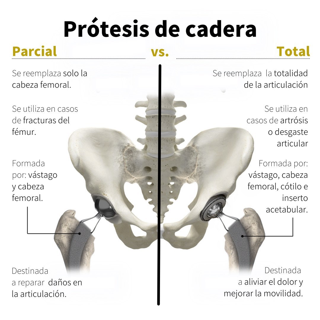 Prótesis de cadera: Tipos y recuperación | Traumadrid