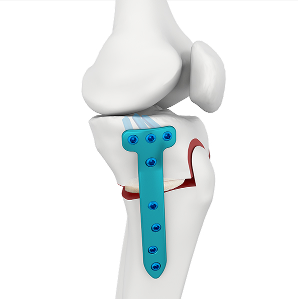 Osteotomía de rodilla: qué es, indicaciones y recuperación | Traumadrid